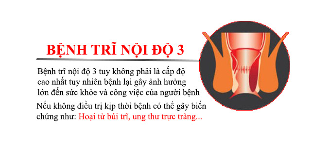 Cần phải điều trị sớm khi bị trĩ nội cấp độ 3